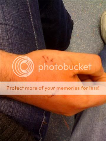 Crocodile Monitor Bite (varanus salvadorii) *Caution Graphic Images ...